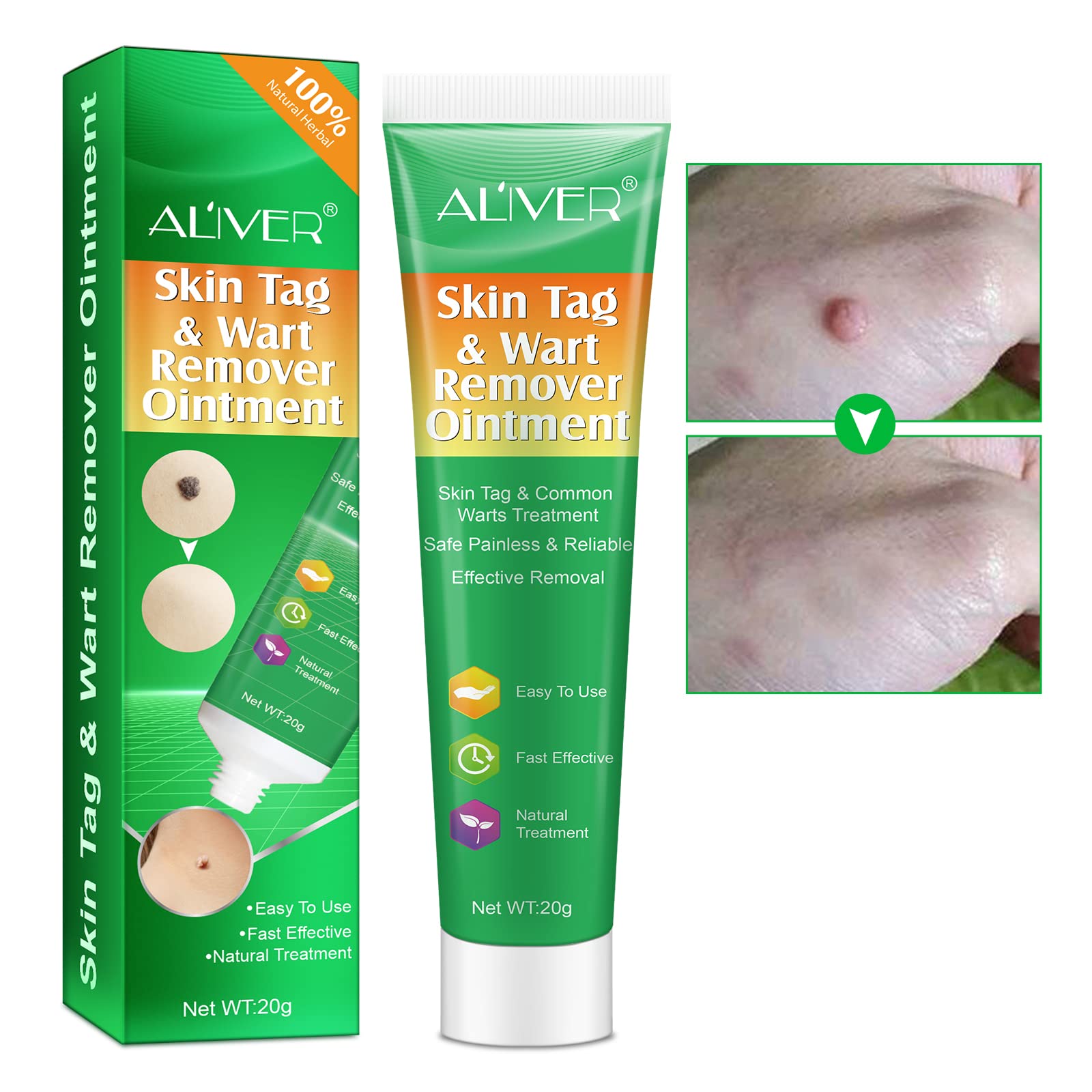 GNAPY Skin Tag & Wart Remover Cream - Natural Treatment Formula for ...