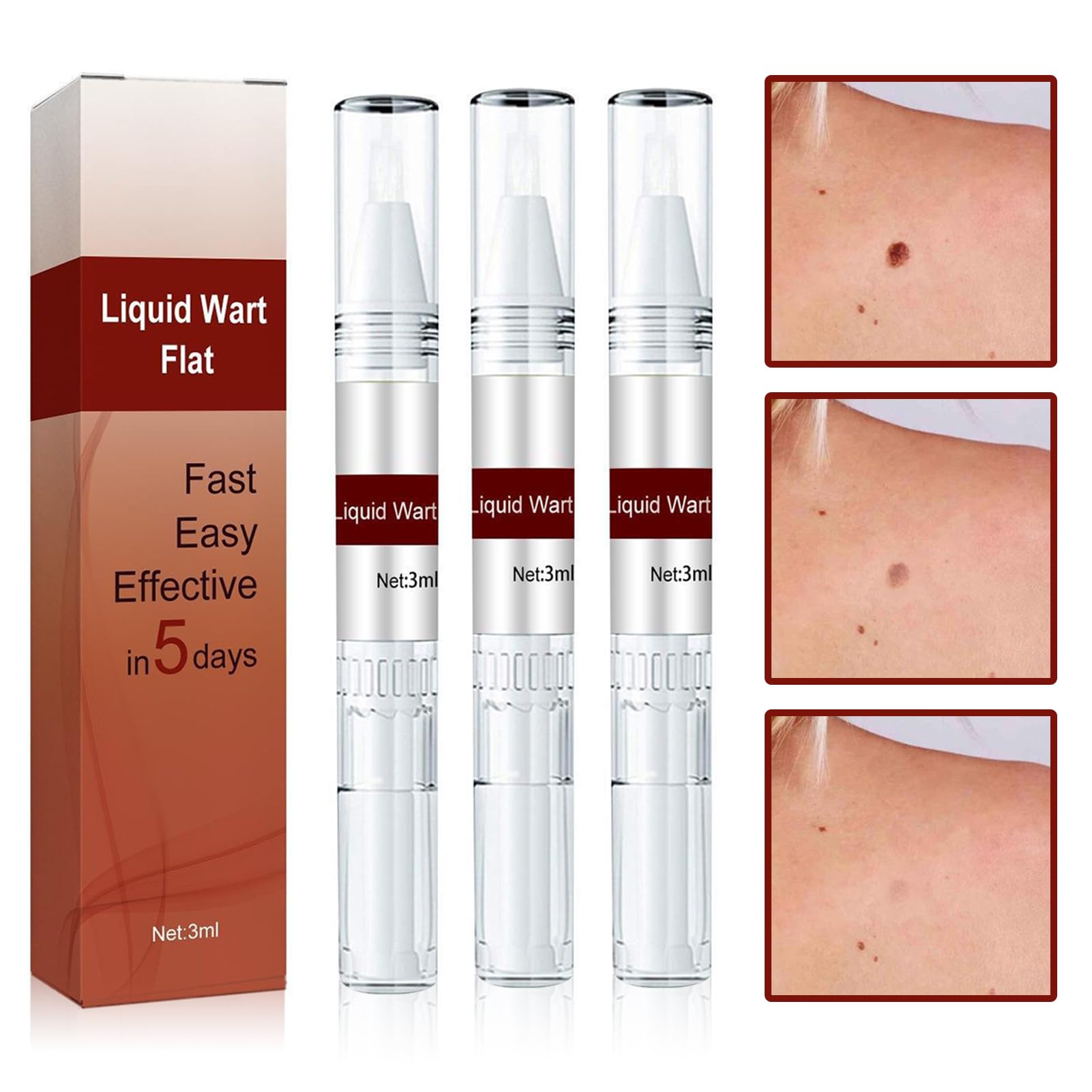 Wipe Off Moles and Skin Tags Remover - Natural Non-Irritating Liquid ...
