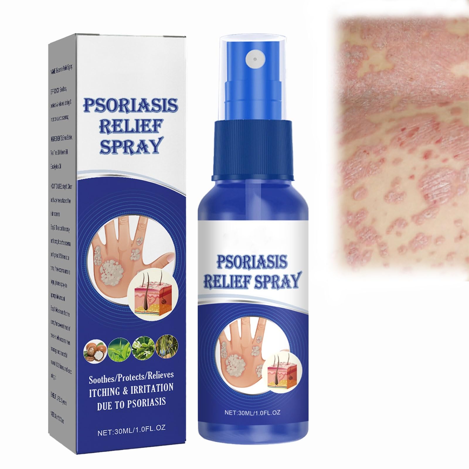 South Moon Psoriasis Repair Spray Herbal Psoriasis Relief Spray