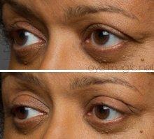 Eye Magic Original Eye Lift Kit - Small/Medium Size with Gel | Lifts ...