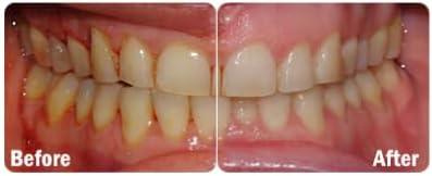 ProBioraPlus Oral-Care Probiotic Mints | Supports Teeth & Gums ...