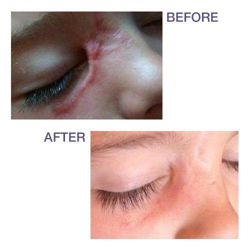 Pro-Sil Silicone Scar Treatment Stick 17g - Clinically Proven to Reduce ...