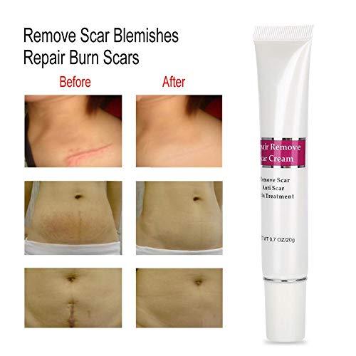 Scar Removal Cream | Anti-Scar Gel for Old Scars, Stretch Marks ...