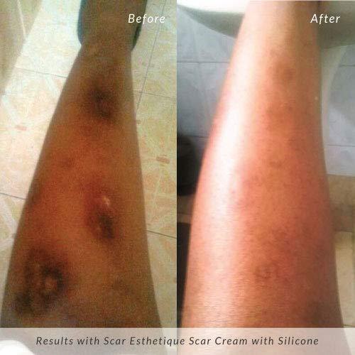 Rejuvaskin Scar Esthetique Cream with Silicone - Reduce Surgical Scars ...