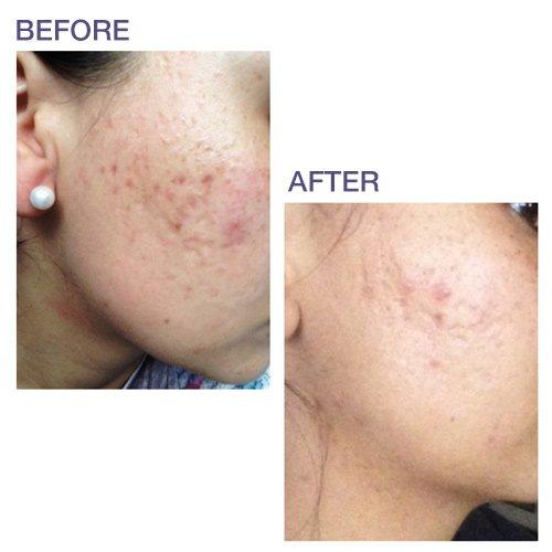Pro-Sil Silicone Scar Treatment Stick 17g - Clinically Proven to Reduce ...