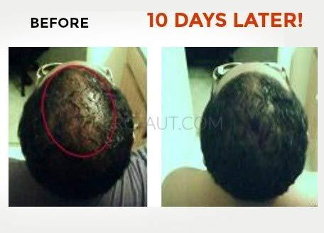 Gro-aut Herbal Hair Growth Oil - Fill Bald Patches, Reverse Hair Loss ...
