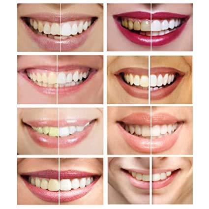 Smile Bright with 15ml Teeth Whitening Gloss - Enhance Your Tooth's ...