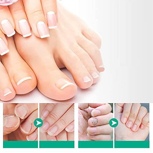 Kerassentials Toenail Treatment Extra Strength - Repair Damaged ...
