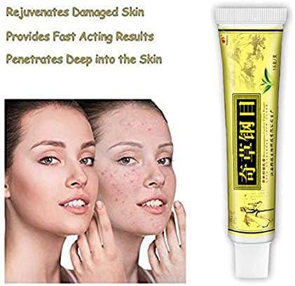 ZORNEPA Herbal Cream for Eczema, Psoriasis & Dermatitis Relief - Anti ...