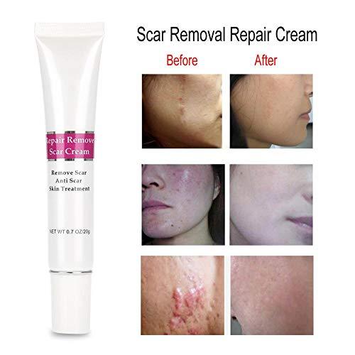 Scar Removal Cream | Anti-Scar Gel for Old Scars, Stretch Marks ...