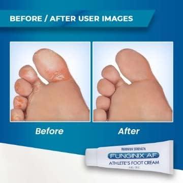 Funginix AF Athlete's Foot Cream - Topical Anti-Fungal Treatment (3 ...