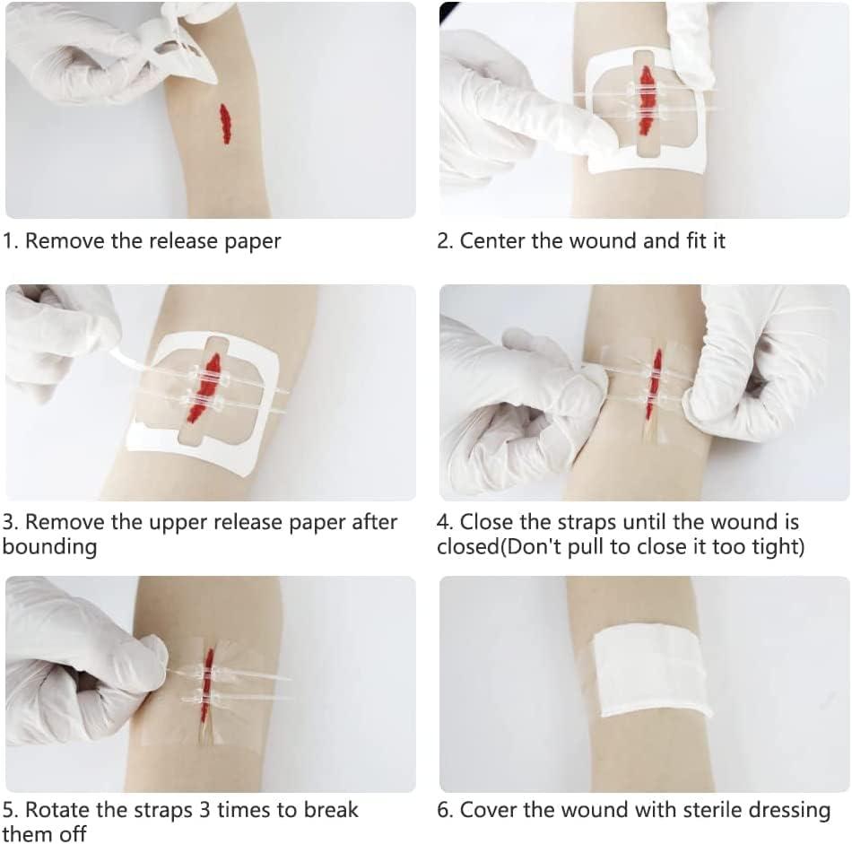 Smerphox Wound Closure Strip - Sterile First Aid Band Kit for Emergency ...