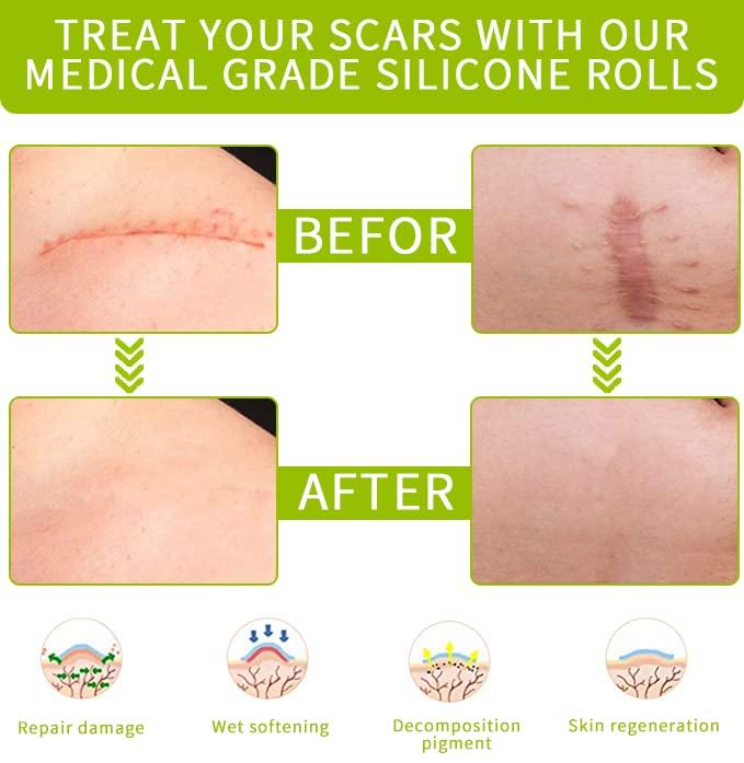 Silicone Scar Tape Roll (3M) - Reusable, Waterproof, 1.6 x 120 inches ...