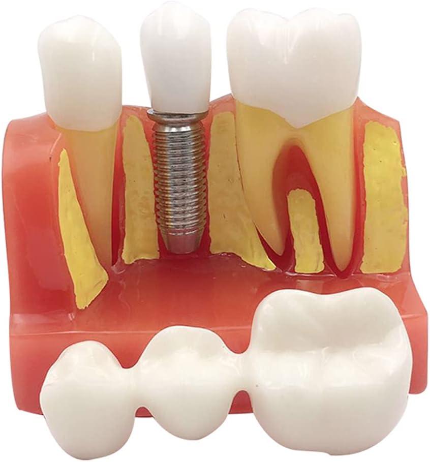 4x Dental Implant Teeth Model with Removable Crown - Crown & Bridge ...