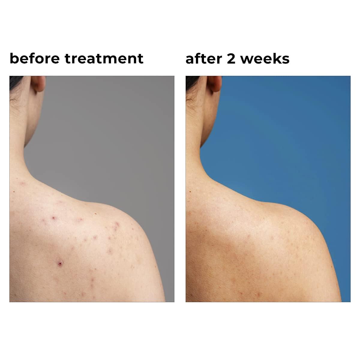 Body Acne Treatment Kit Pimple Clearing For Chest Shoulder Back