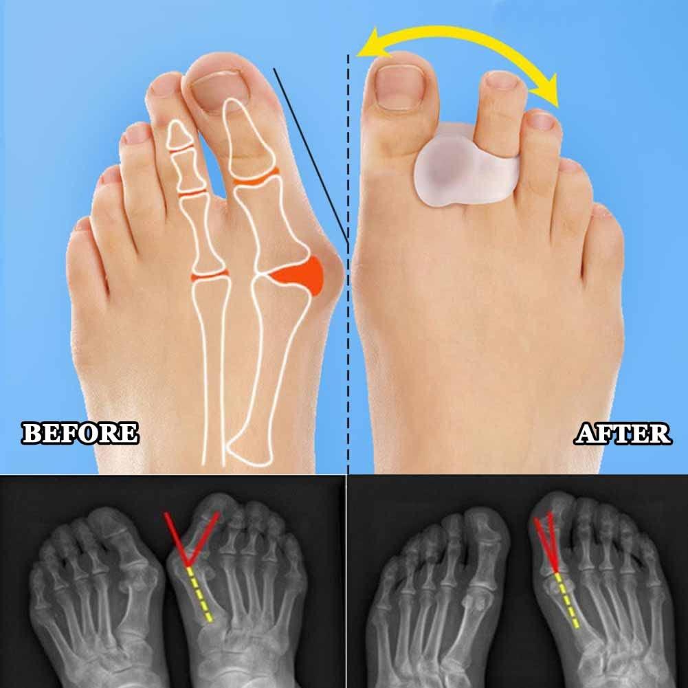 Gel Toe Separators 8 Pack Toe Corrector Bunions Splint Big Toe ...