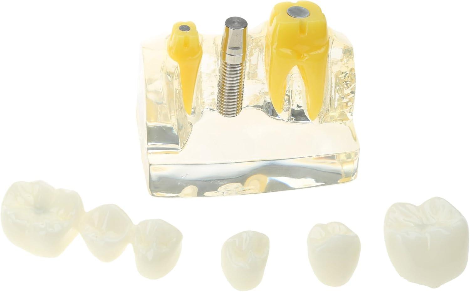 Implant Model Removable Bridge - Educational Teeth Model for Dental ...