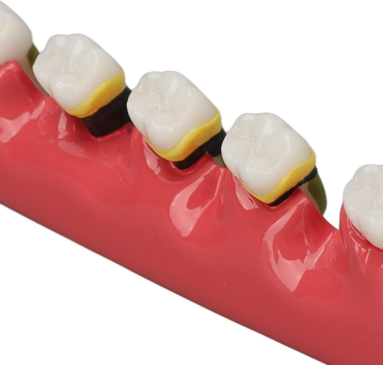 Dental Model for Periodontitis - Realistic Teaching Aid Resin Model for ...