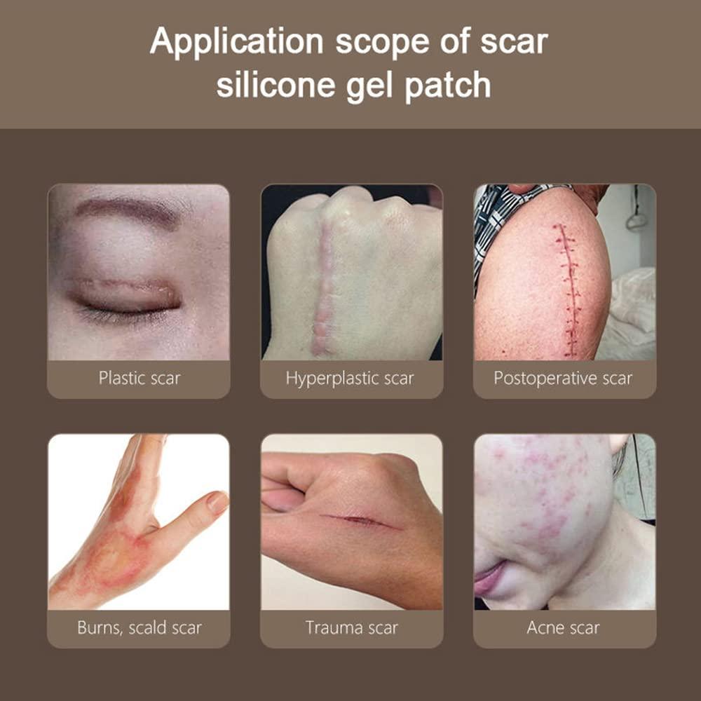 Medical Grade Silicone Scar Sheets for Surgical, C-Section, Burn & Acne ...