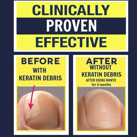 NONYX Nail Gel - Toenail Fungus Treatment for Clearing Fungus ...