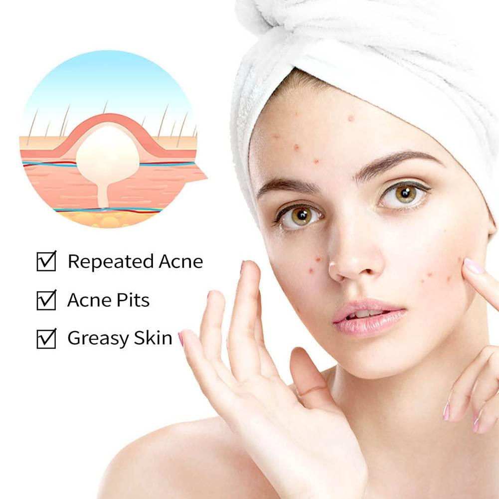 Onkessy Repair Acne Cream - Pimple Treatment for Men and Women ...