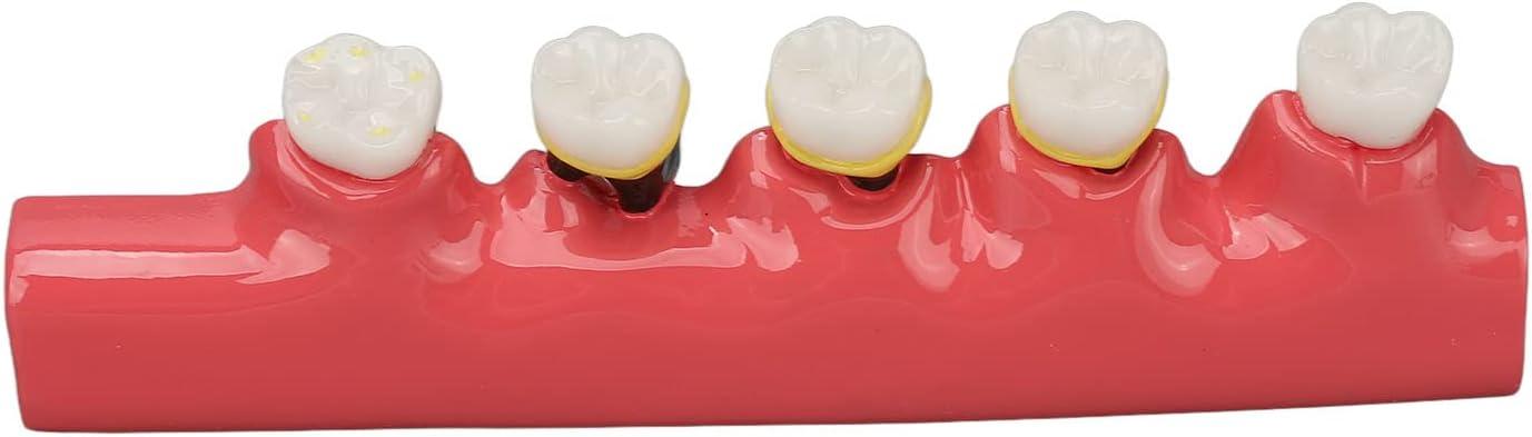 Realistic Dental Periodontitis Model - Study Dental Teeth in Various ...
