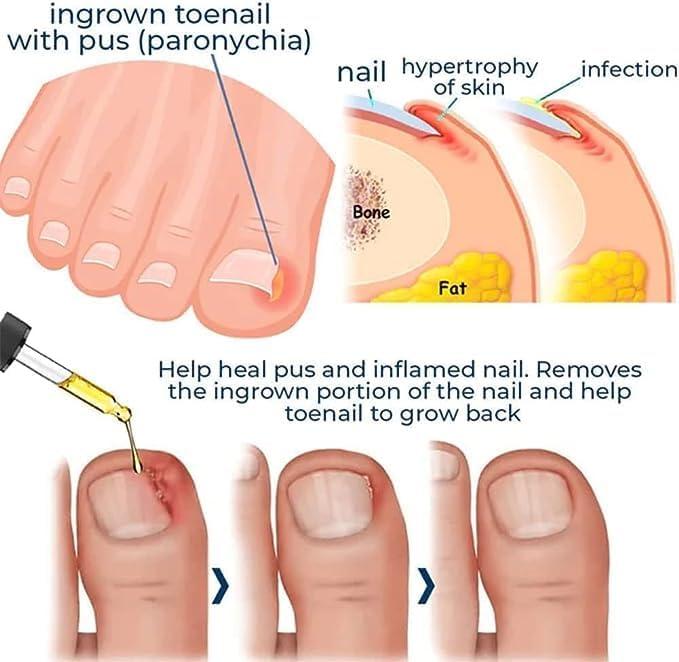 (100% Effective) KYOSK 10ml German Anti Paronychia Relief Oil Anti ...