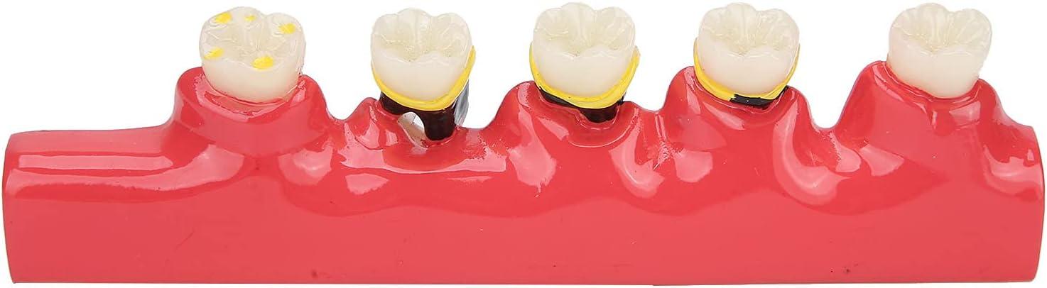 Dental Periodontitis Model | Periodontal Development Study Tool for ...