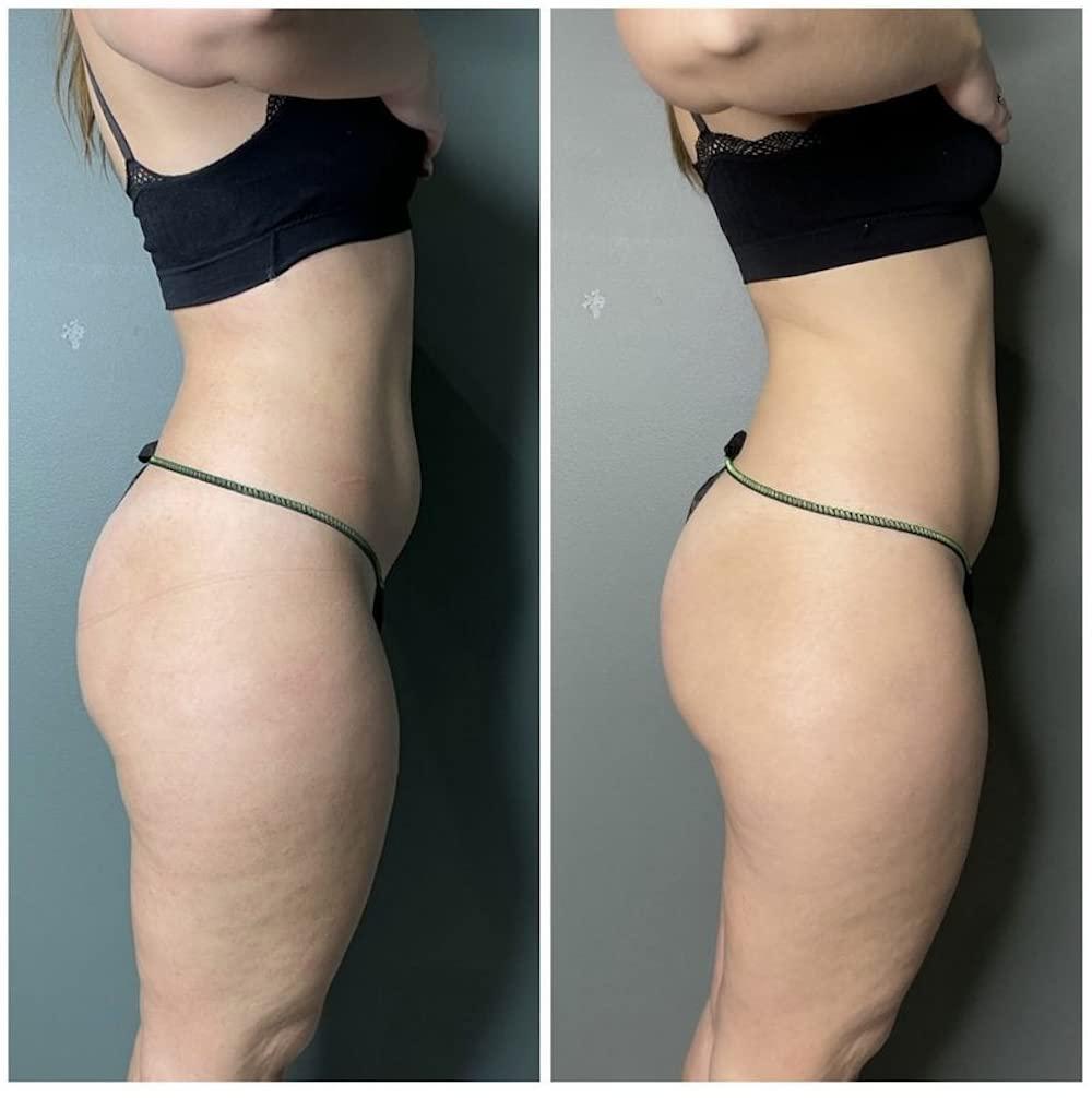 body wrap cellulite
