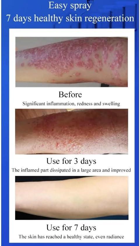 NEUKIN Eczema Itching Skin Health Spray Vitiligo Psoriasis Relief Spray ...