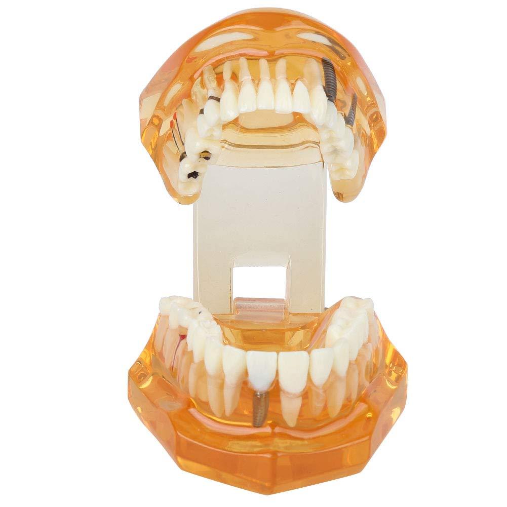 1-Piece Orange Tooth Model for Dental Education | Removable Denture ...