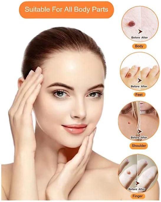 Mole & Skin Tag Removal Kit - Professional 2-in-1 Painless & Safe Wart ...