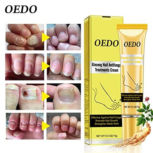 OEDO Anti-Fungal Cream - 15g Relief for Itchy Cracks & Scaly Skin ...