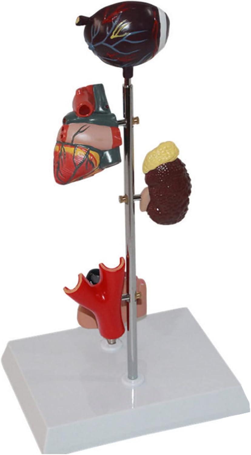 Comprehensive Human Diabetes Model: Intraocular Retinopathy Cataracts ...