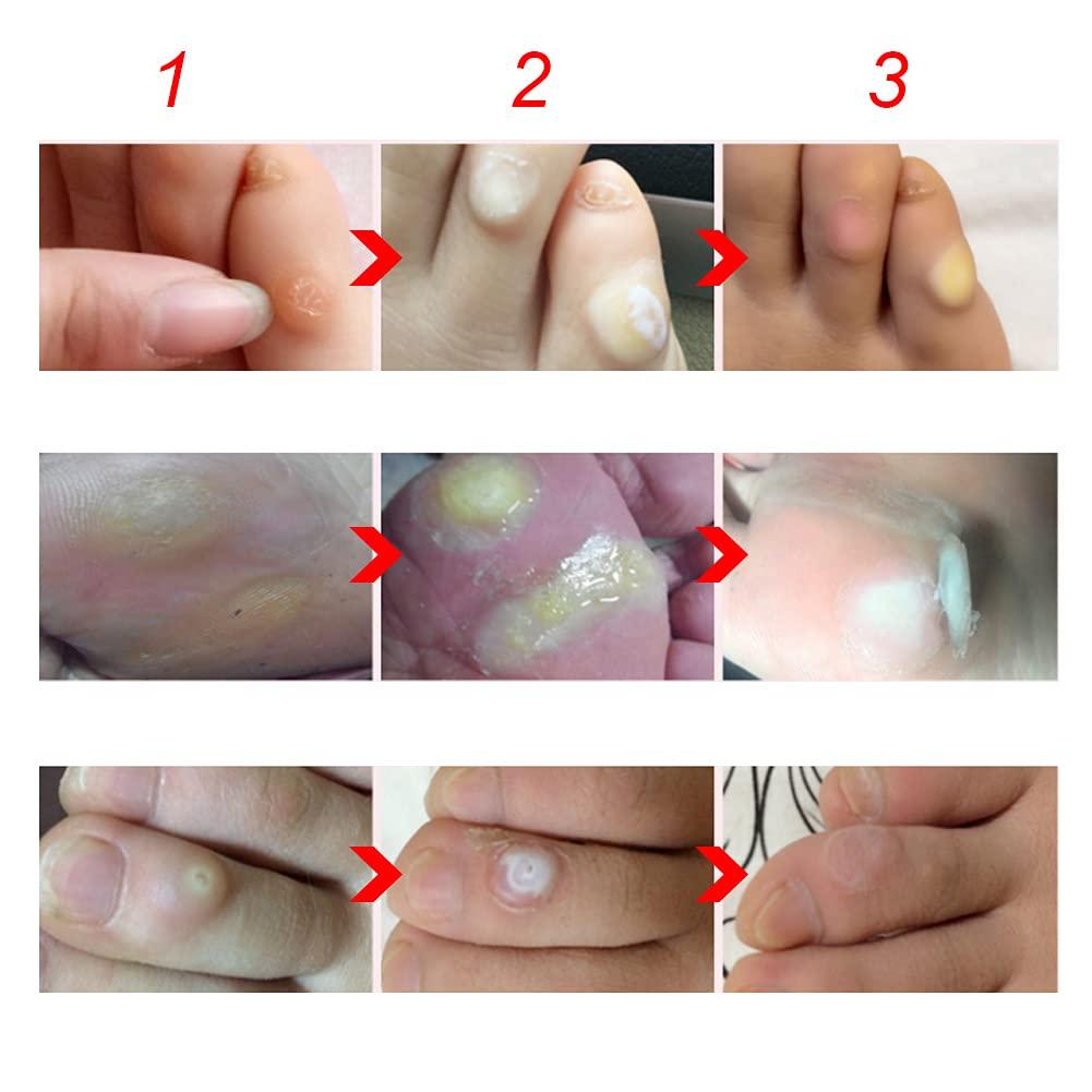 Foot Corn Plaster Foot Toes Corn Callus Removal Cream Pad Pain Friction ...