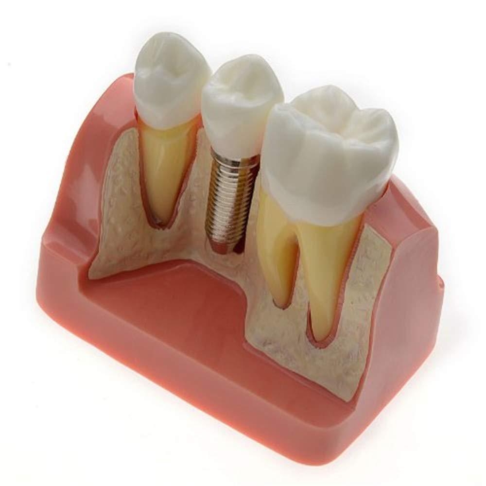 Dental Implant Analysis Demonstration Model - Crown Bridge Teeth ...