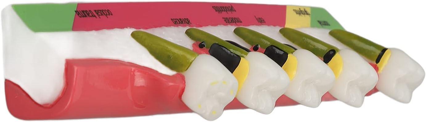 Dental Model for Periodontitis - Realistic Teaching Aid Resin Model for ...