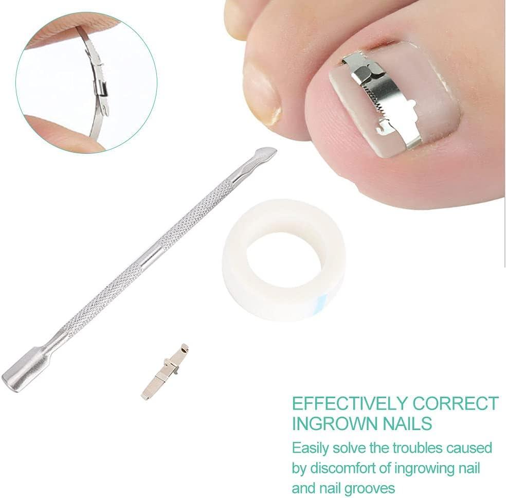 Ingrowing Nail Corrector Ingrown Toenails Correction Paronychia ...