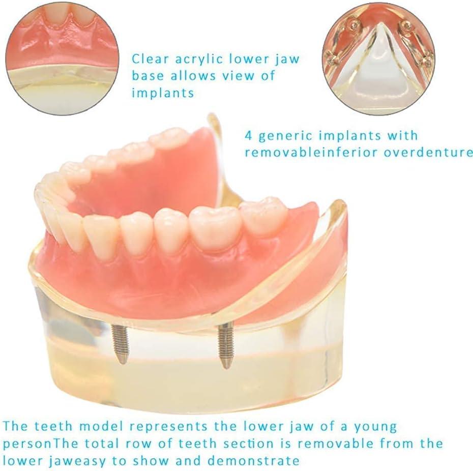 Dental Model Overdenture with 4 Implants - Ideal for Teaching ...