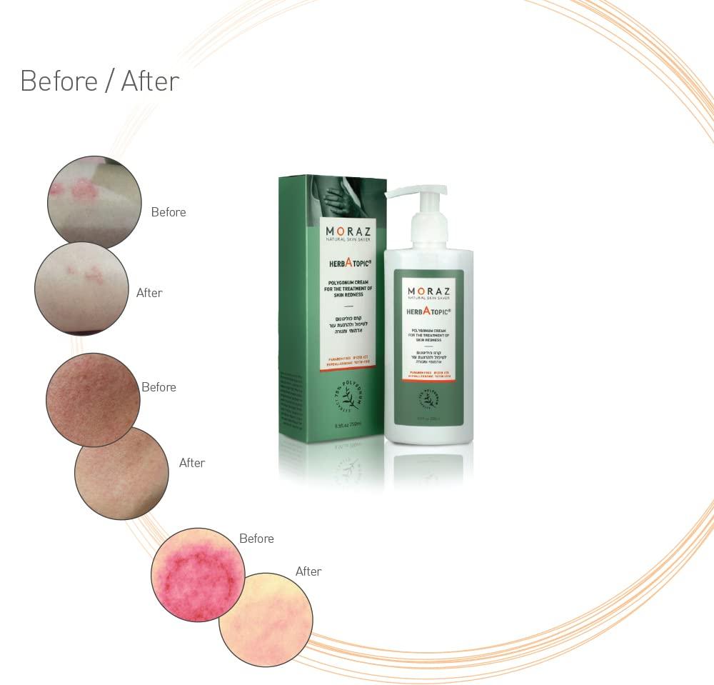 Moraz Hand Cream and Skin Rash Cream - Soothe, Hydrate & Nourish ...