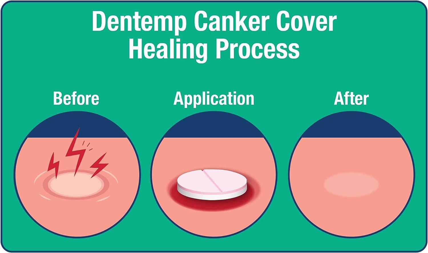Dentemp Canker Cover - Fast Acting Canker Sore Relief Tablets (6 Count ...