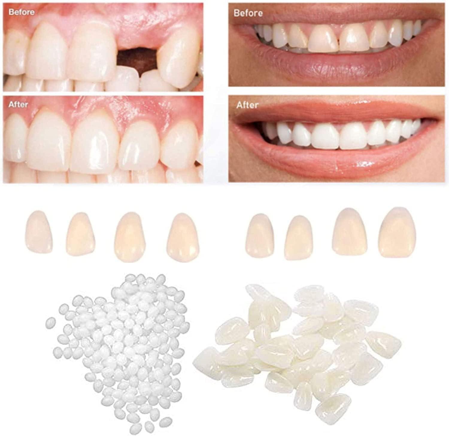 Tooth Repair Kit-Temporary Fixing Irregular & Deformity Teeth or ...