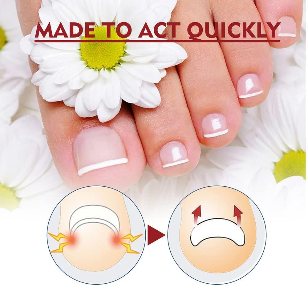 Buy German Toenailplus Anti Paronychia Relief Oil - Ingrown Toenail ...