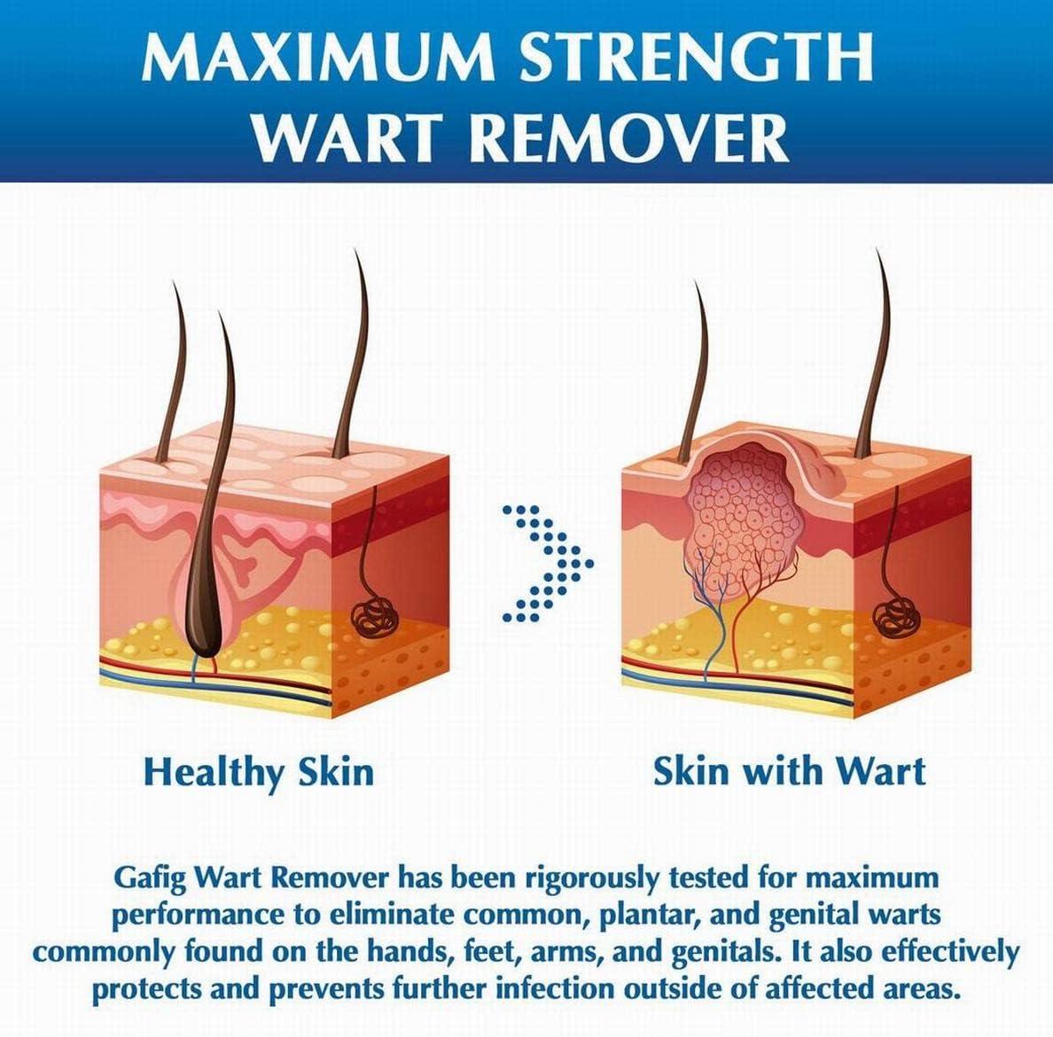 plantar wart skin diagram