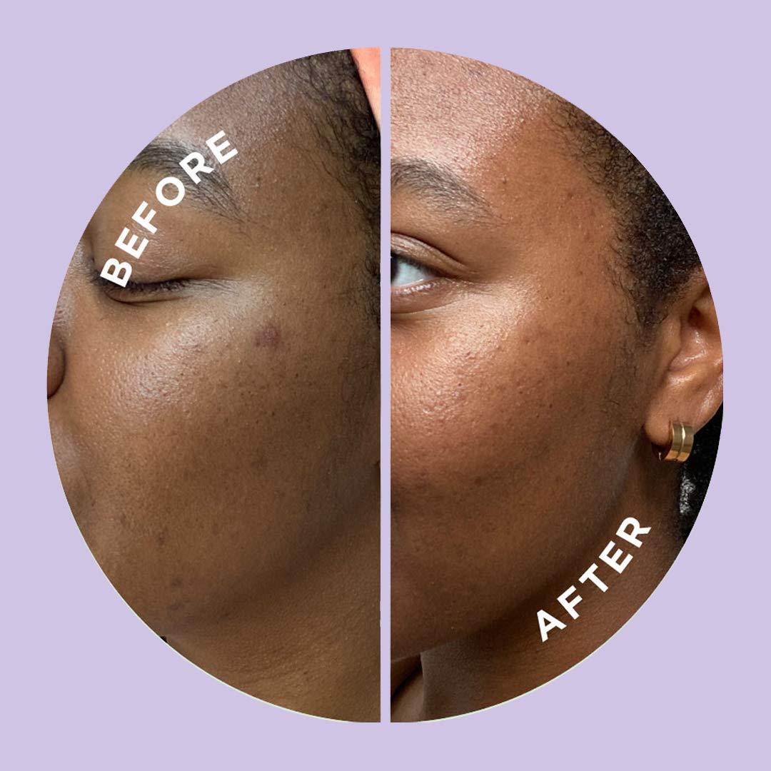 HYPERFADE by ZitSticka Microdart Patch - Fade Post-Zit Dark Spots | Buy ...