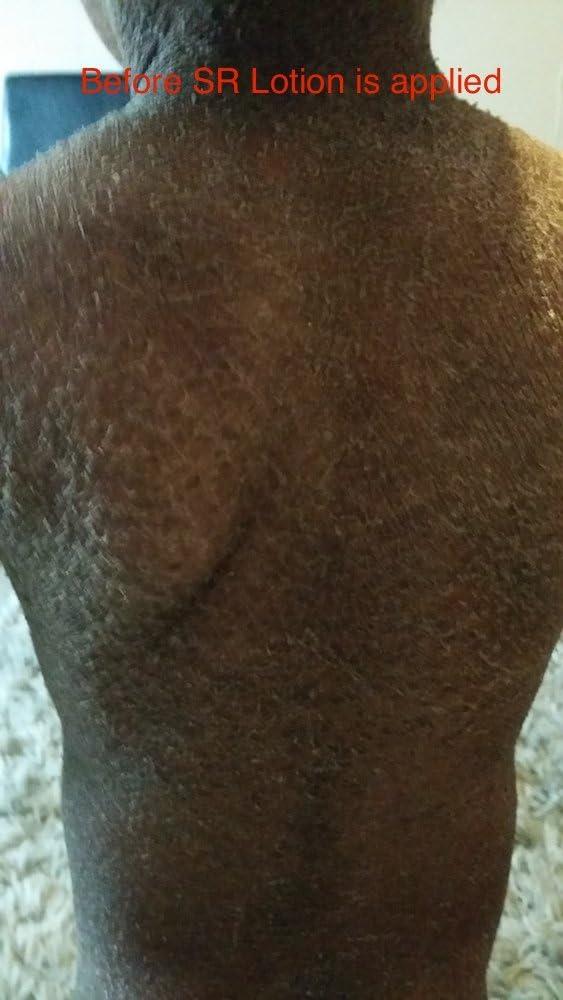 G16 Skin Repair Lotion: Effective Ichthyosis Treatment Cream for ...