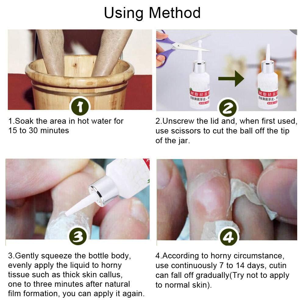 Foot Corn Plaster - Callus & Corn Removal Cream for Pain Relief - 10ml ...