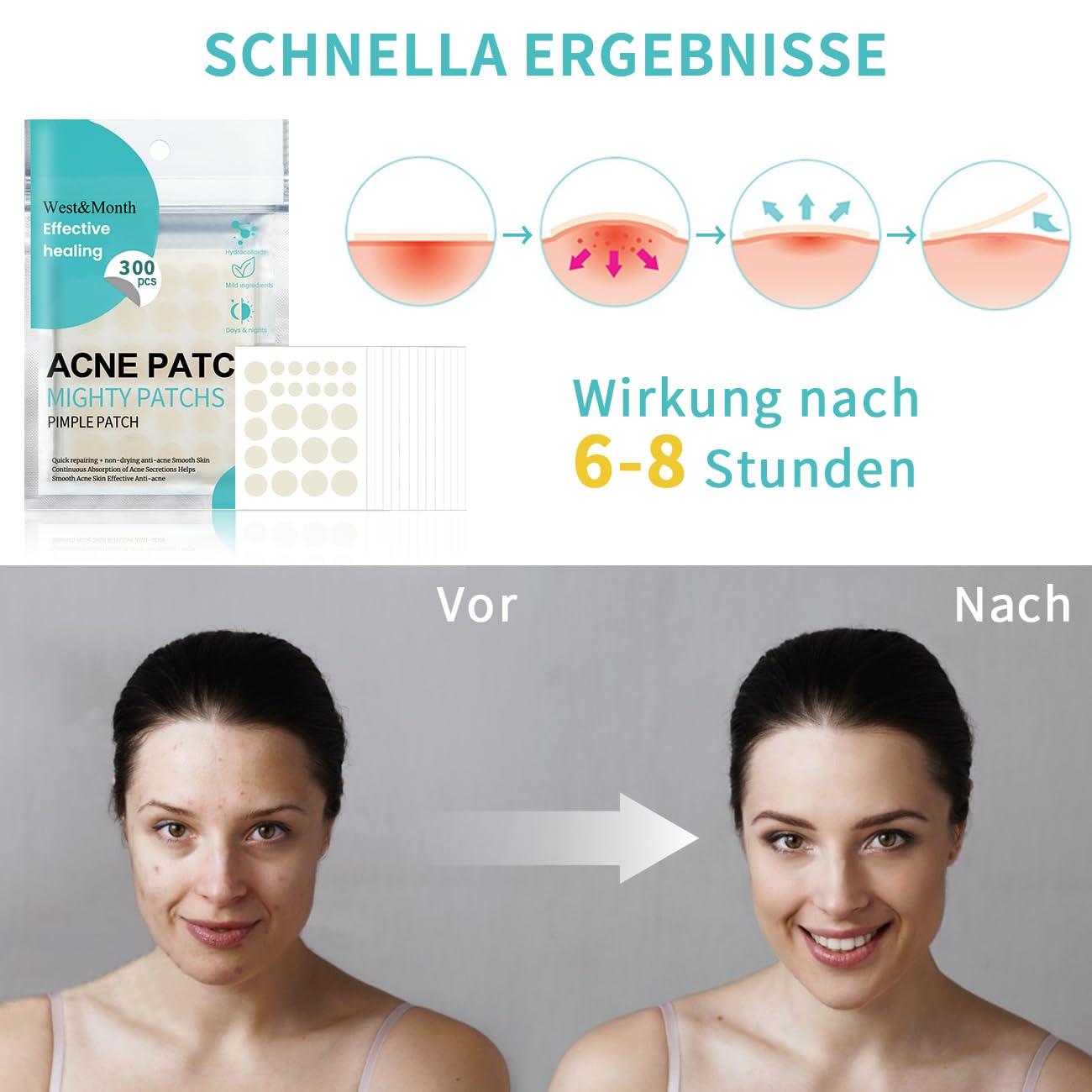 Day & Night 2-in-1 Waterproof Pimple Patches | Anti-Acne with Tea Tree ...