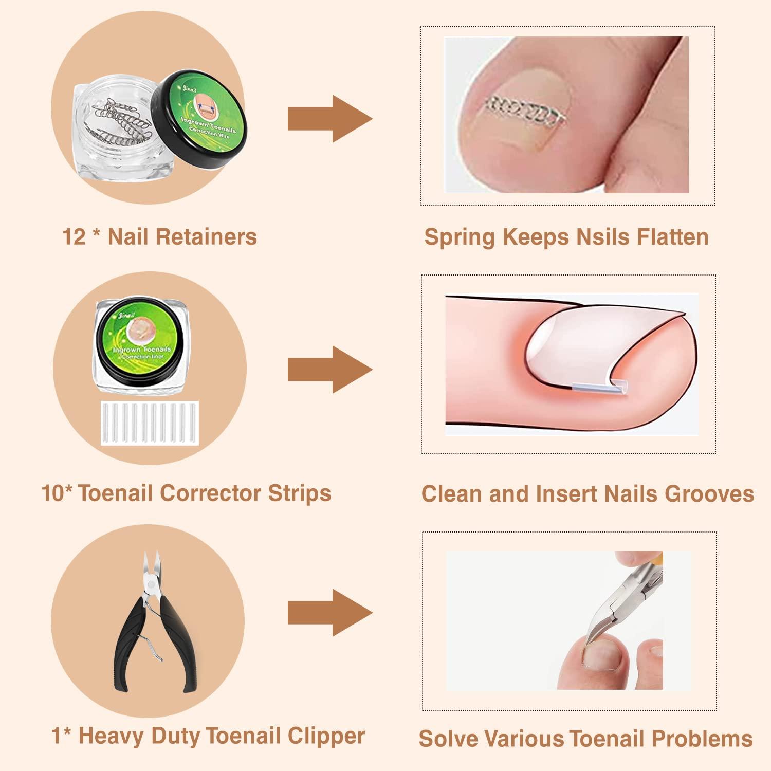 107PCS Ingrown Toenail Removal Kit - Toe Nail Corrector Tool for Pain ...