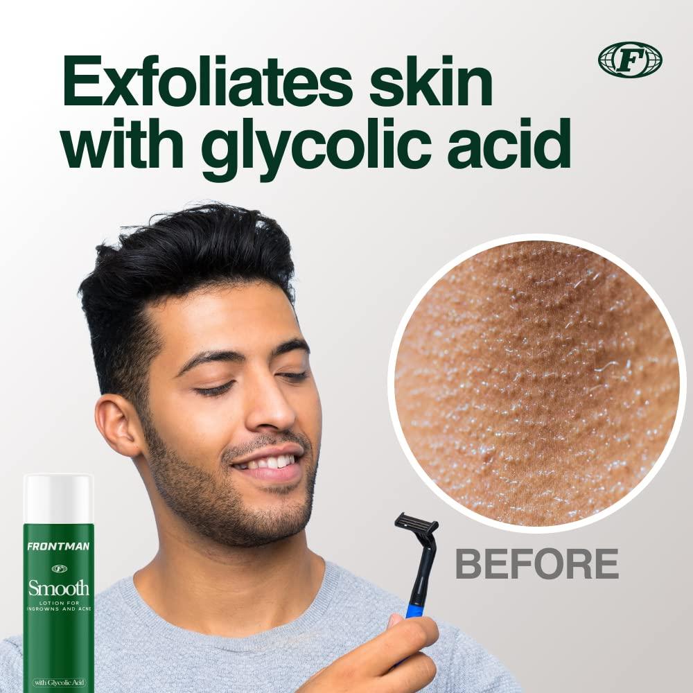 FRONTMAN Smooth - Glycolic Acid Ingrown Hair Treatment for Men - 1.7 Fl ...